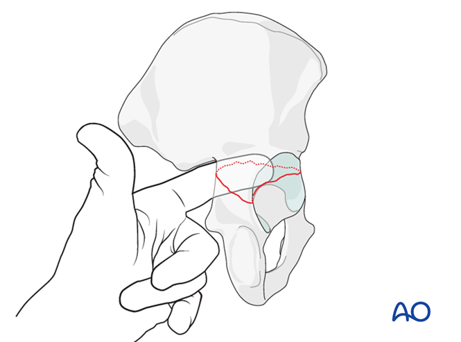 ORIF through extended iliofemoral approach for Transverse
