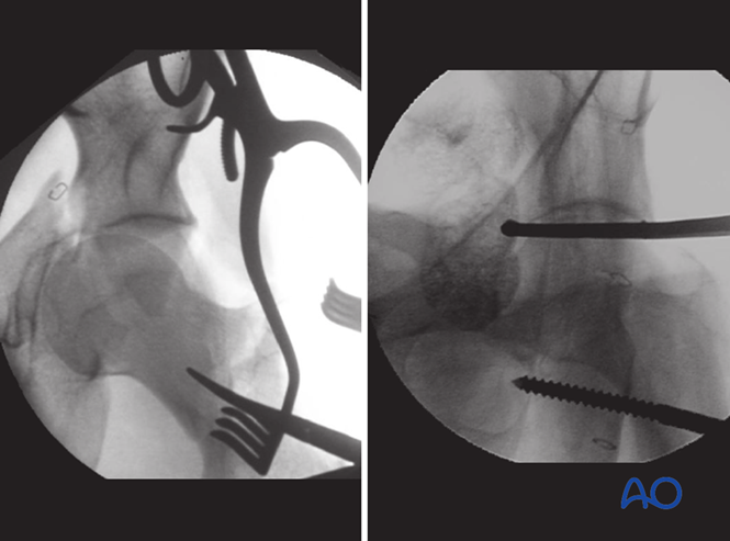 ORIF through Kocher-Langenbeck for Transverse