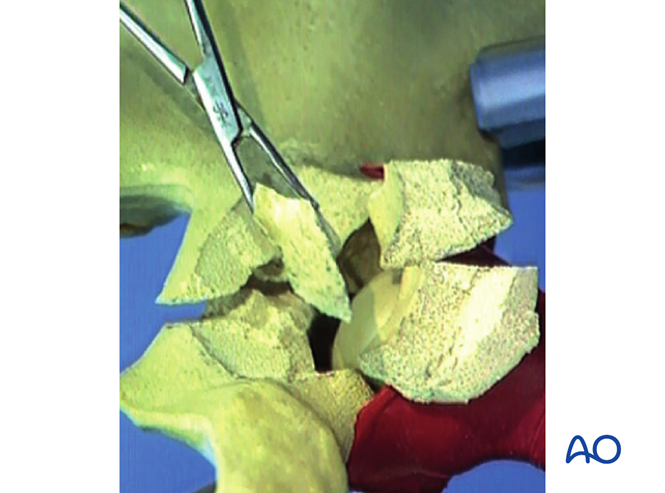 ORIF through Kocher-Langenbeck for Transverse and posterior wall