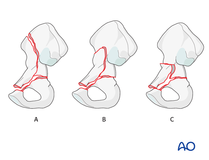ORIF through ilioinguinal approach for Anterior column and posterior ...