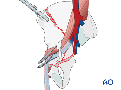 ORIF through ilioinguinal approach for Anterior column and posterior ...