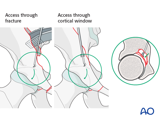 ORIF through ilioinguinal approach for Anterior column and posterior ...
