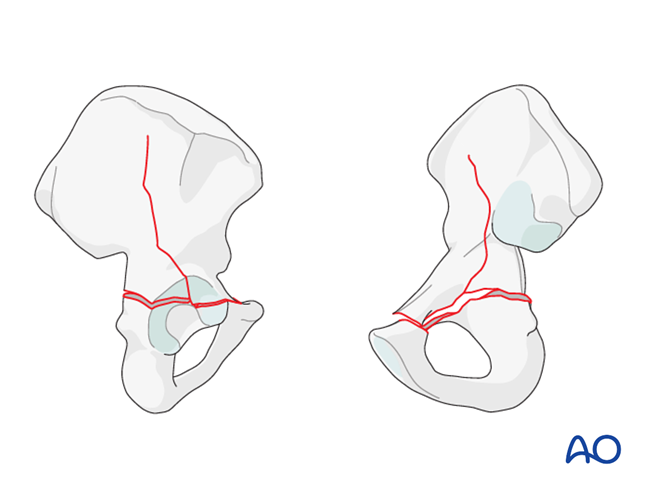 ORIF through ilioinguinal approach for Anterior column and posterior ...