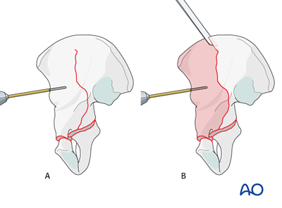 ORIF through ilioinguinal approach for Anterior column and posterior ...