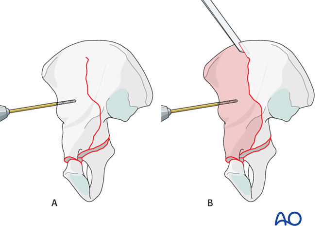 ORIF through ilioinguinal approach for Anterior column and posterior ...