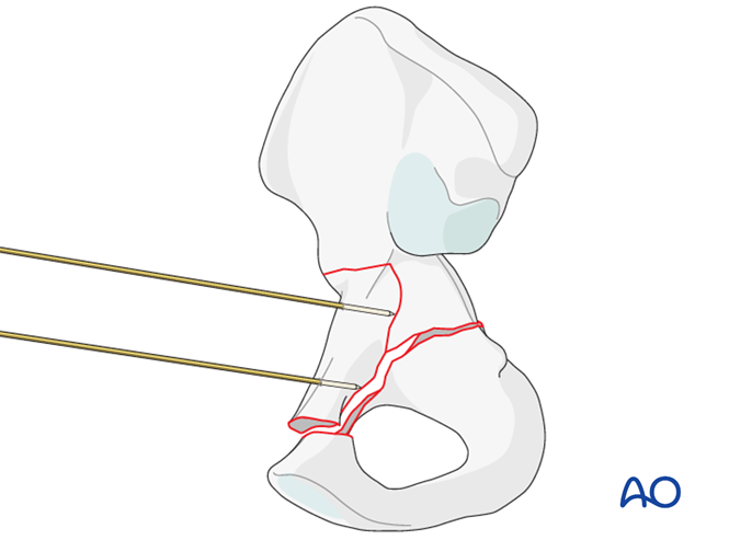 ORIF through ilioinguinal approach for Anterior column and posterior ...
