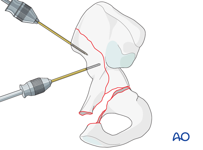 ORIF through ilioinguinal approach for Anterior column and posterior ...