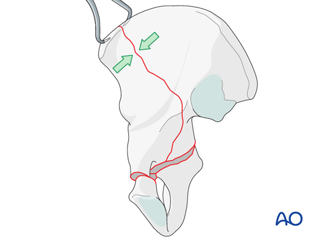 ORIF through ilioinguinal approach for Anterior column and posterior ...