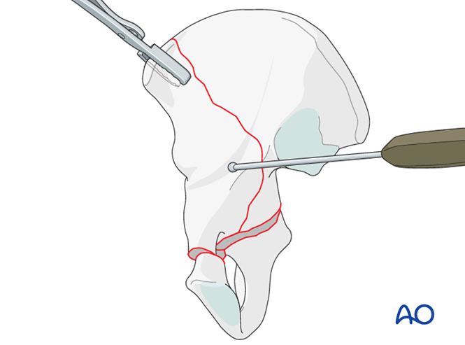 ORIF through ilioinguinal approach for Anterior column and posterior ...