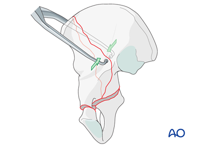 ORIF through ilioinguinal approach for Anterior column and posterior ...