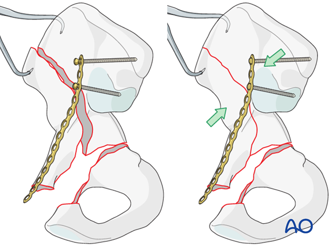 ORIF through ilioinguinal approach for Anterior column and posterior ...