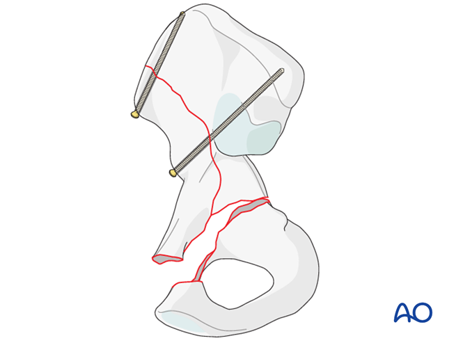 ORIF through ilioinguinal approach for Anterior column and posterior ...