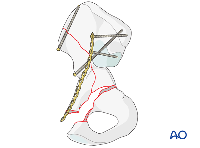 ORIF through ilioinguinal approach for Anterior column and posterior ...