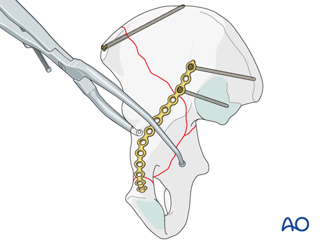 ORIF through ilioinguinal approach for Anterior column and posterior ...