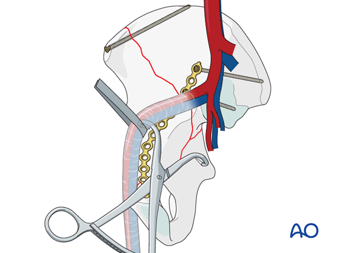 ORIF through ilioinguinal approach for Anterior column and posterior ...