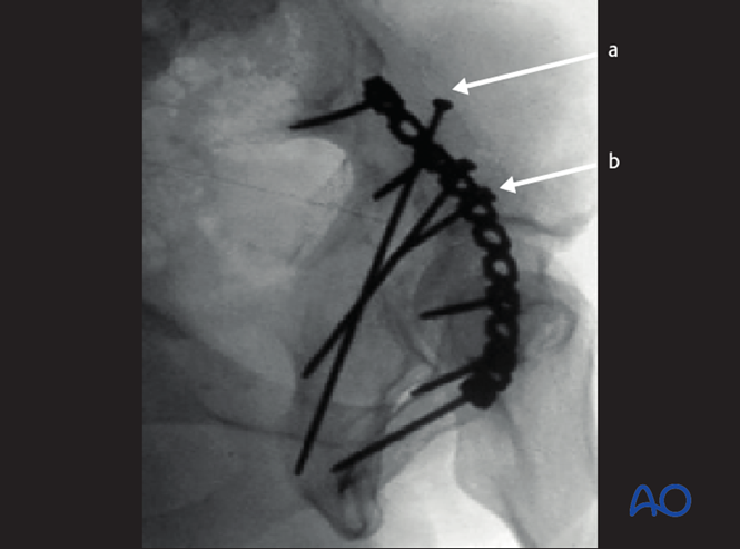 ORIF through ilioinguinal approach for Anterior column and posterior ...