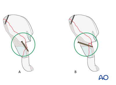 ORIF through ilioinguinal approach for Anterior column and posterior ...