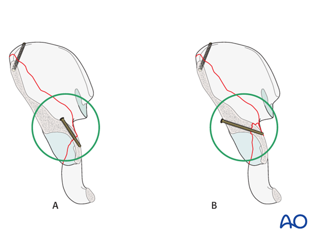 ORIF through ilioinguinal approach for Anterior column and posterior ...