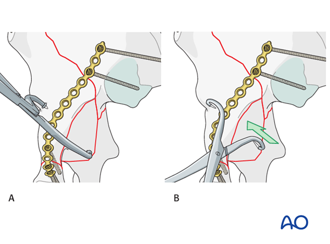 ORIF through ilioinguinal approach for Anterior column and posterior ...