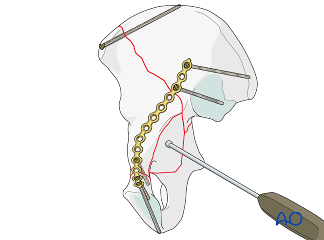 ORIF through ilioinguinal approach for Anterior column and posterior ...