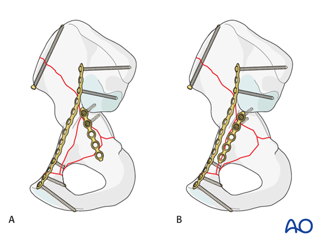 ORIF through ilioinguinal approach for Anterior column and posterior ...