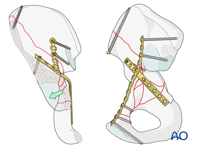 ORIF through ilioinguinal approach for Anterior column and posterior ...