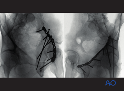ORIF through modified Stoppa approach for Anterior column and posterior ...