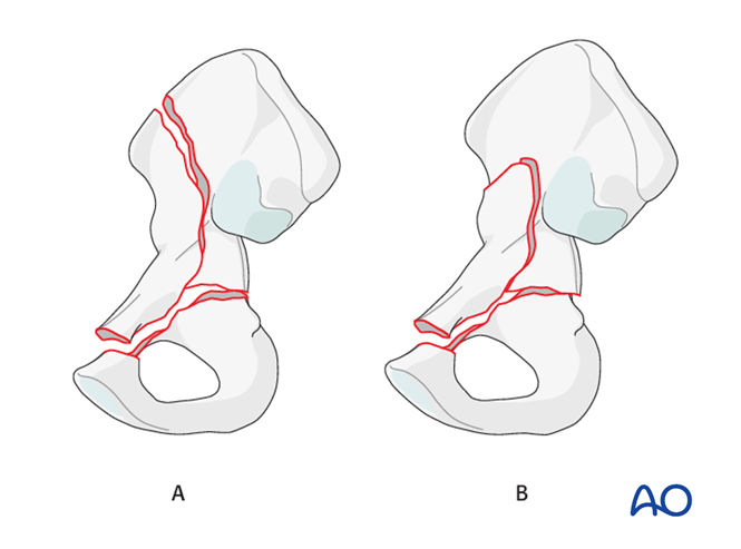 ORIF through modified Stoppa approach for Anterior column and posterior ...
