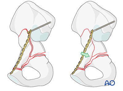 ORIF through modified Stoppa approach for Anterior column and posterior ...