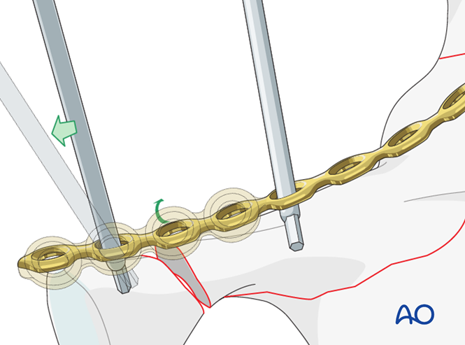 ORIF through modified Stoppa approach for Anterior column and posterior ...
