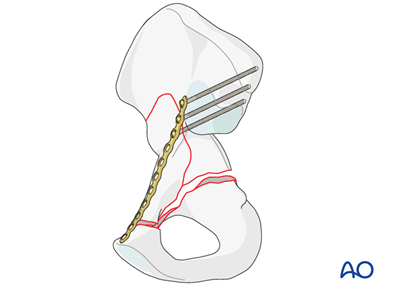 ORIF through modified Stoppa approach for Anterior column and posterior ...