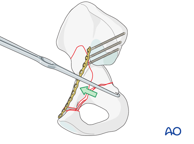 ORIF through modified Stoppa approach for Anterior column and posterior ...
