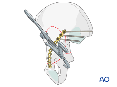 ORIF through modified Stoppa approach for Anterior column and posterior ...