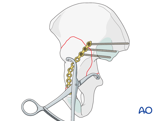 ORIF through modified Stoppa approach for Anterior column and posterior ...