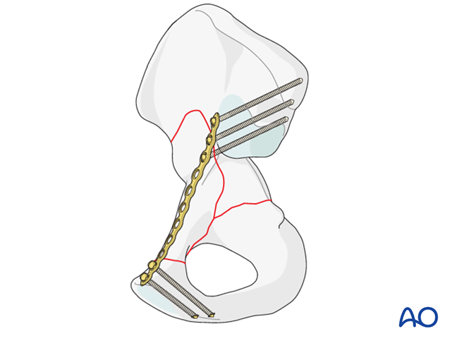 ORIF through modified Stoppa approach for Anterior column and posterior ...