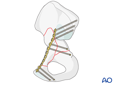 ORIF through modified Stoppa approach for Anterior column and posterior ...