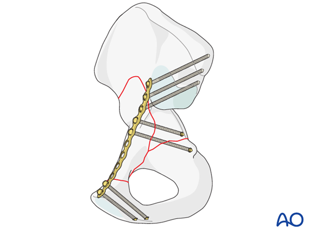 ORIF through modified Stoppa approach for Anterior column and posterior ...