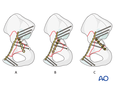 ORIF through modified Stoppa approach for Anterior column and posterior ...