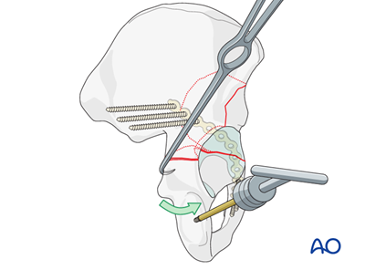 ORIF through sequential approaches for Anterior column and posterior ...