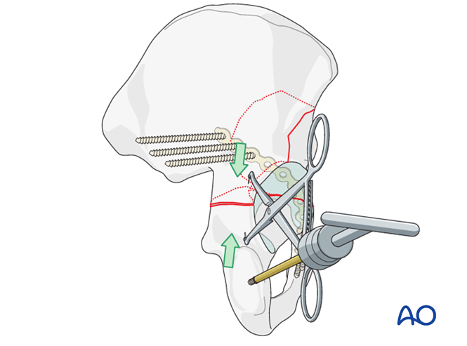 ORIF through sequential approaches for Anterior column and posterior ...