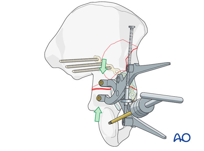 ORIF through sequential approaches for Anterior column and posterior ...
