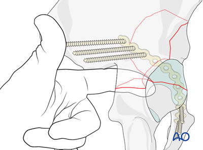 ORIF through sequential approaches for Anterior column and posterior ...