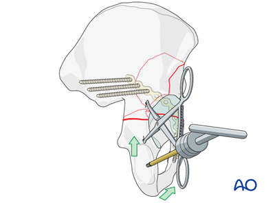 ORIF through sequential approaches for Anterior column and posterior ...