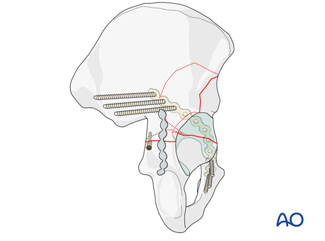 ORIF through sequential approaches for Anterior column and posterior ...