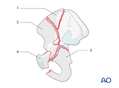 ORIF through ilioinguinal approach for Both columns