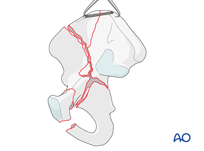 ORIF through ilioinguinal approach for Both columns