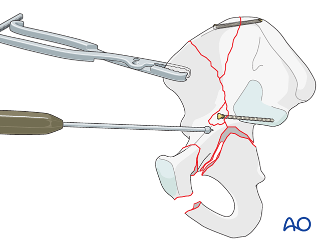 ORIF through ilioinguinal approach for Both columns