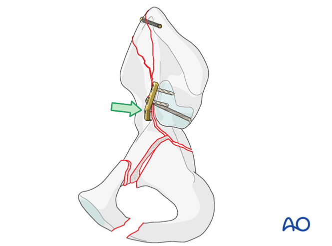 ORIF through ilioinguinal approach for Both columns