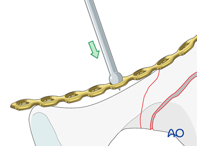 ORIF through modified Stoppa approach for Both columns