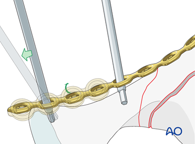 ORIF through modified Stoppa approach for Both columns